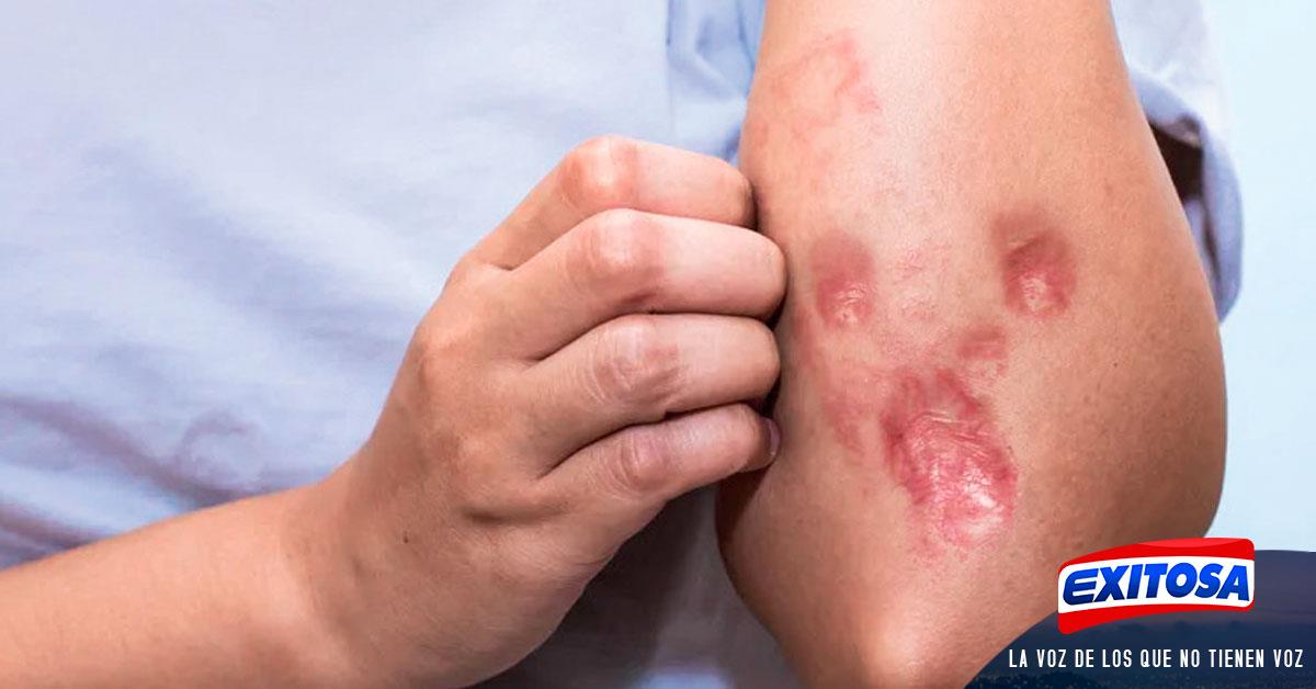 En Familia | Todo sobre los queloides en la piel - Exitosa Noticias