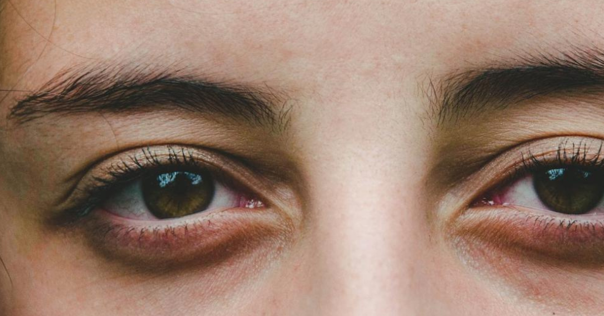 ¿Ojeras?: Prueba estos 5 ingredientes naturales para reducir las bolsas ...